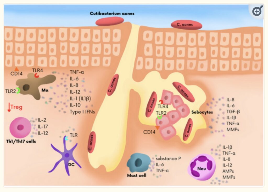 Acne: Root Causes & Personal Solutions