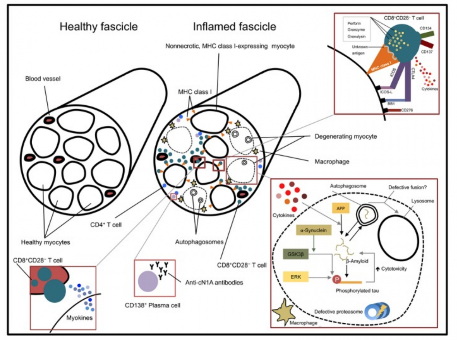 Inclusion Body Myositis: Genomics and Solutions