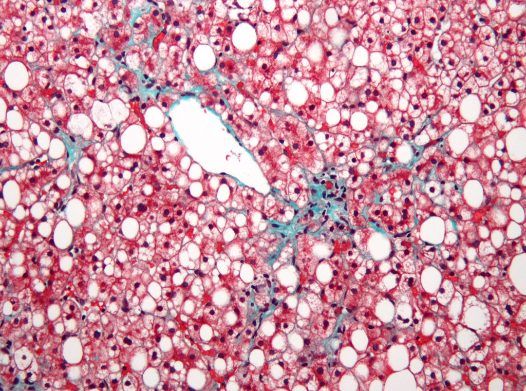 Fatty Liver Disease: Genetics and Reasons for NAFLD