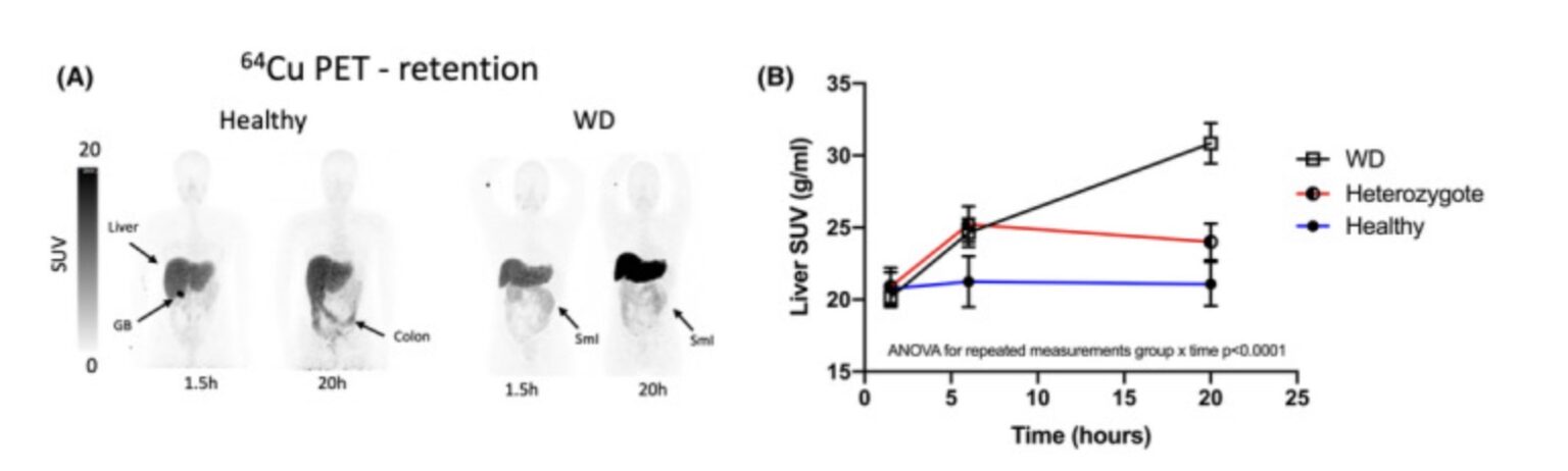 Wilson's disease: ATP7B Gene Mutations and Copper Accumulation in the Brain