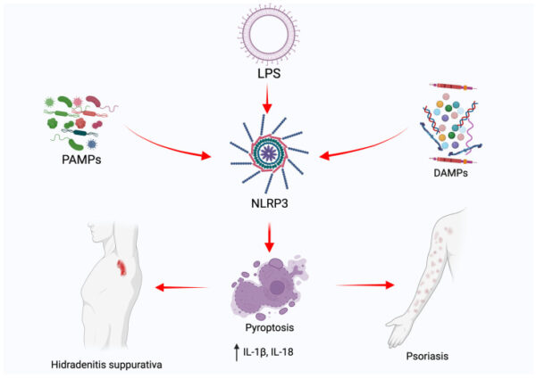 Hidradenitis Suppurativa: Genetic Causes and Possible Solutions